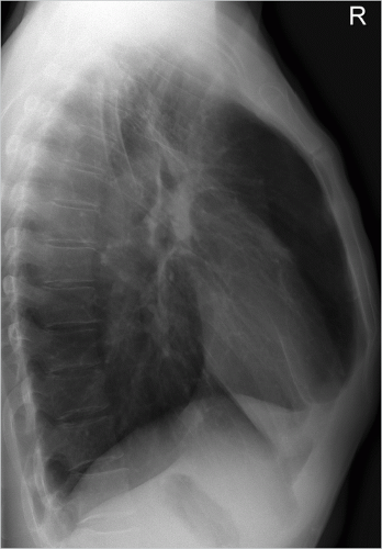 Diseases of the Chest Wall and Diaphragm | Radiology Key