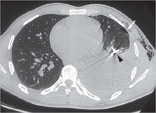 Chest Trauma | Radiology Key
