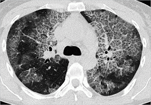 Persistent or Migratory Pulmonary Infiltrates | Radiology Key