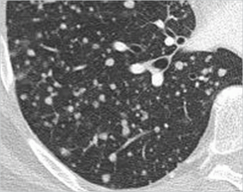 Fleischner Society Glossary of Terms for Thoracic Imaging | Radiology Key
