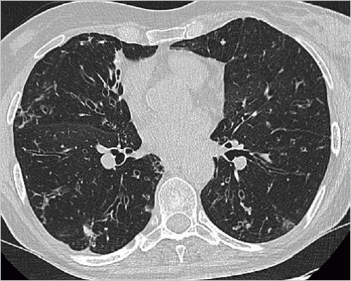 Pneumonia | Radiology Key