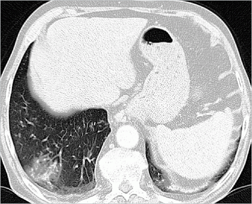 Immunologic Diseases of the Lung | Radiology Key