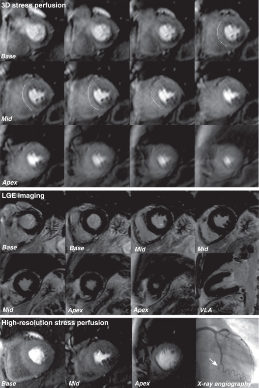 Myocardial Perfusion Cardiovascular Magnetic Resonance: Advanced ...