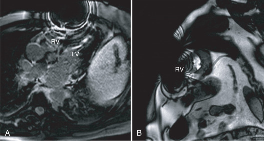 Special Considerations for Cardiovascular Magnetic Resonance: Safety ...