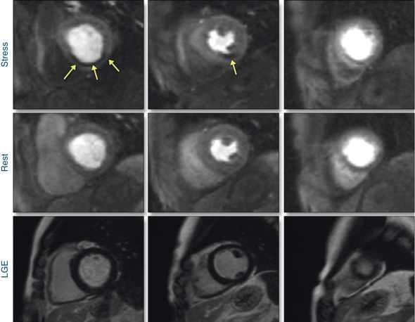 Myocardial Viability | Radiology Key
