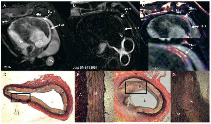Atherosclerotic Plaque Imaging: Coronaries | Radiology Key