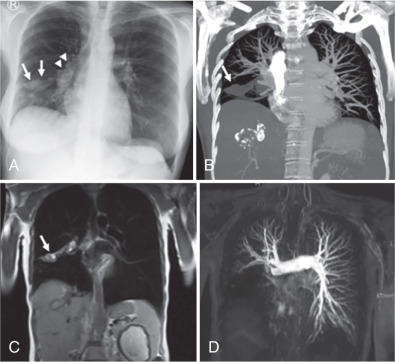 Pulmonary Artery | Radiology Key