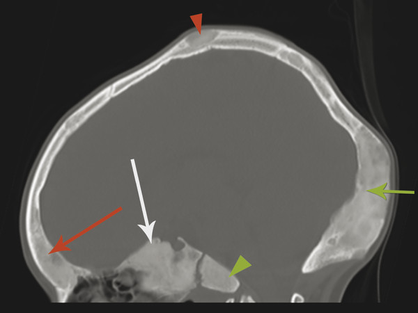 7 Neurocutaneous | Radiology Key