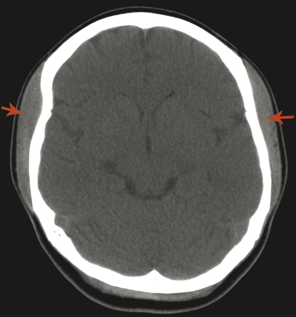 Normal CT Soft Tissue Neck