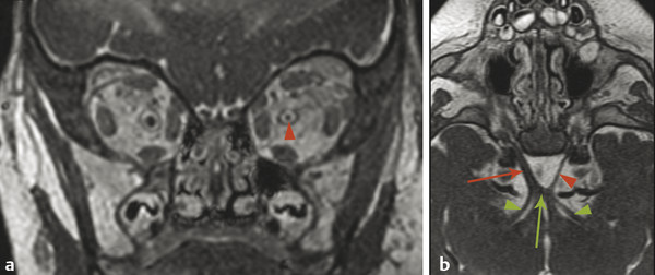 21 Orbits | Radiology Key
