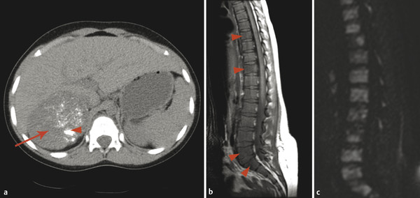 27 Neoplasm | Radiology Key