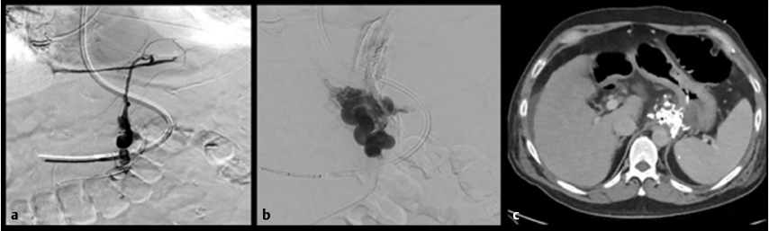 6 Management of Complications of Portal Hypertension: Balloon-Occluded ...