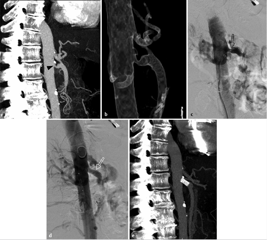 10 Mesenteric Ischemia | Radiology Key