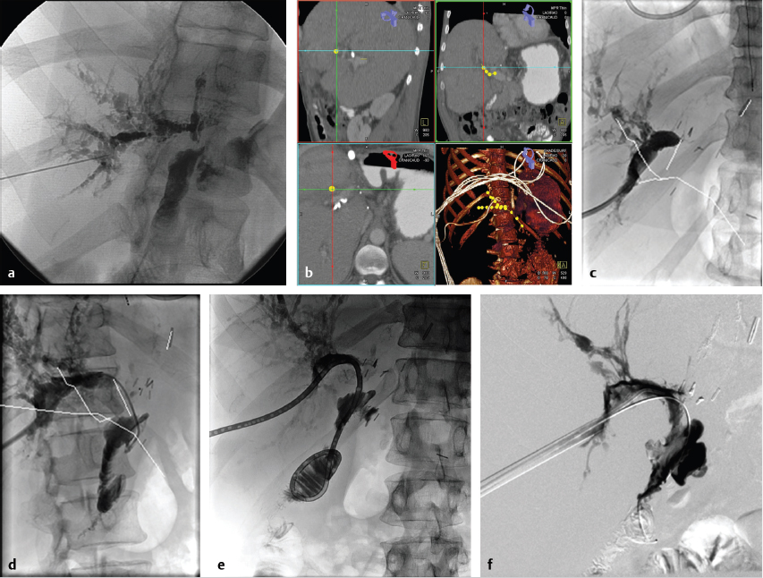 11 Benign Biliary Strictures | Radiology Key