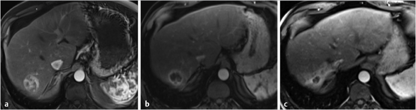 23 Yttrium-90 Radioembolization of Malignant Liver Tumors | Radiology Key