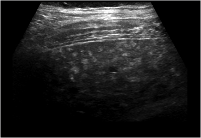 25 Islet Cell Transplantation | Radiology Key
