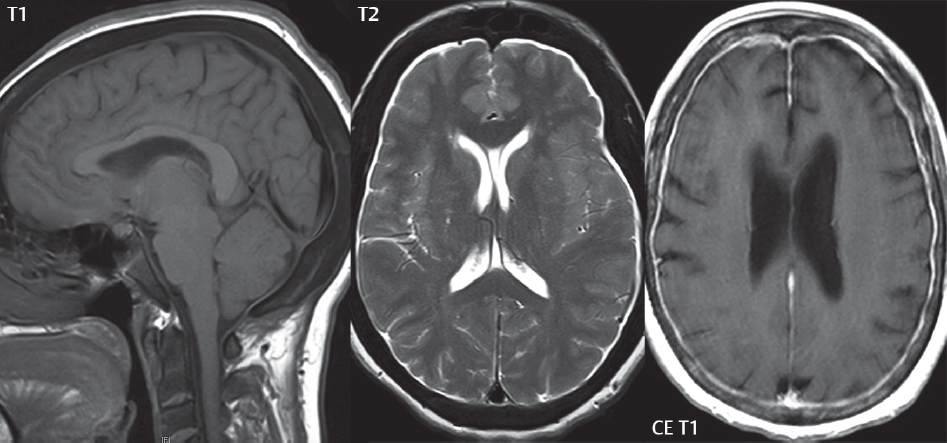 Cerebrospinal Fluid Disorders | Radiology Key
