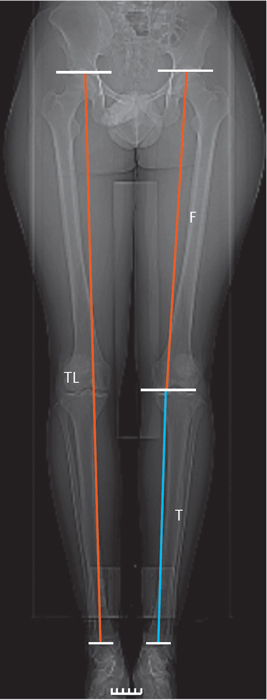 Lower Limb Alignment Radiology Key