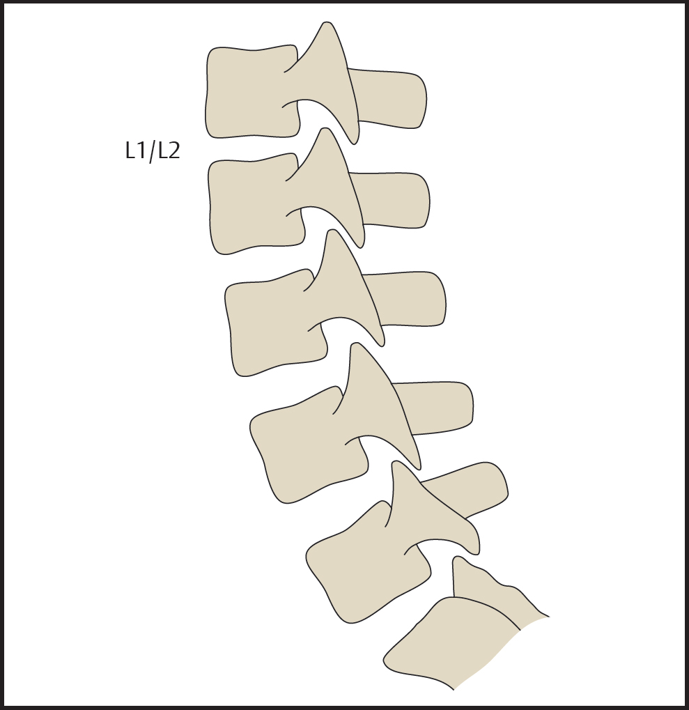 Spine(I) | Radiology Key