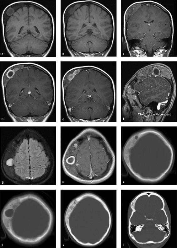 2.1 Sclerotic Changes | Radiology Key