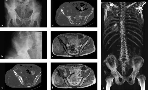 4.1 Sclerotic Changes | Radiology Key