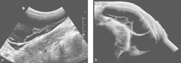8 Peritoneal Cavity and Retroperitoneal Space | Radiology Key