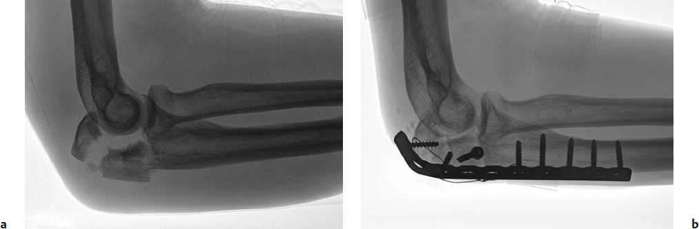 Elbow Trauma | Radiology Key