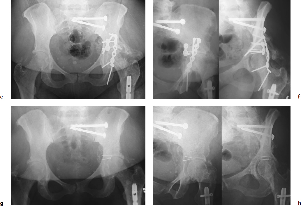 Acetabular Fractures | Radiology Key