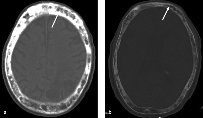 9 Hyperostosis Frontalis Interna | Radiology Key