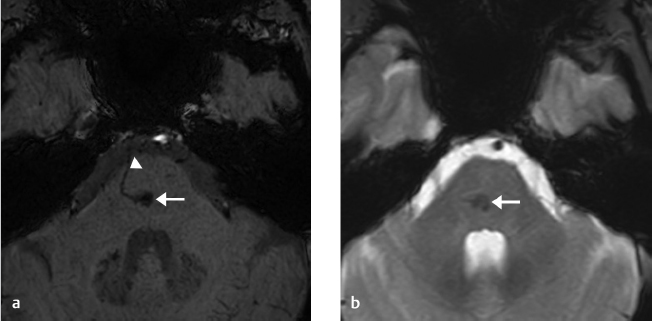 13 Brain Capillary Telangiectasias | Radiology Key