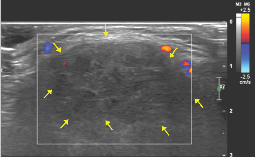 37 Thyroid Mass | Radiology Key
