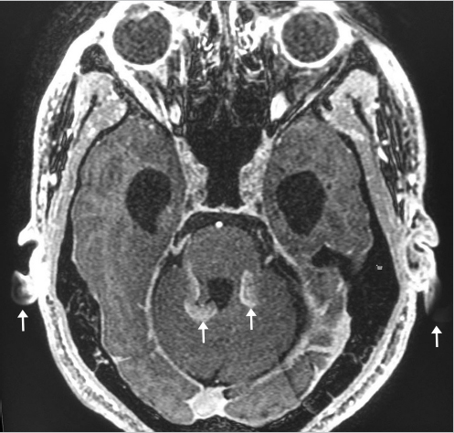 44 MRI Technical and Sequence-Specific Artifacts | Radiology Key