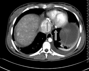 MR Imaging Evaluation of Pericardial Constriction | Radiology Key