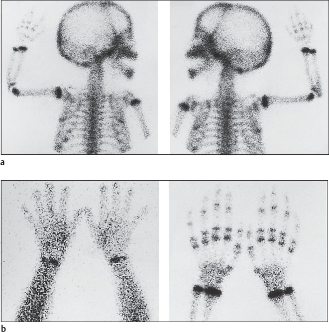 6 Skeletal Scintigraphy | Radiology Key