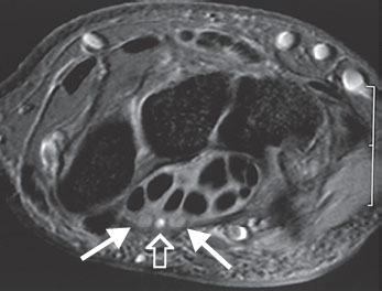 15 Normal Variants of the Skeleton and the Soft Tissues of the Hand ...