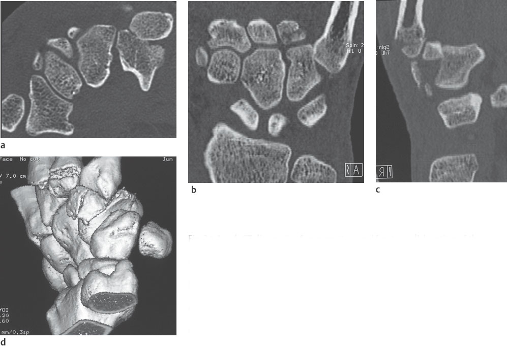 24 Carpometacarpal Dislocations and Fracture-Dislocations | Radiology Key
