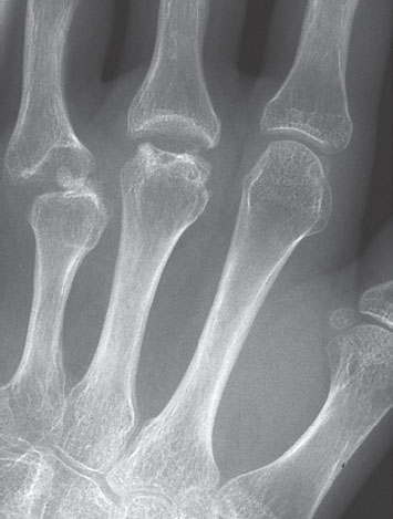 30 Osteonecrosis of the Hand Skeleton | Radiology Key
