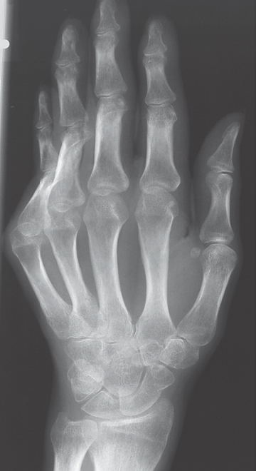 38 Rheumatic Fever (Poststreptococcal Reactive Arthritis) | Radiology Key