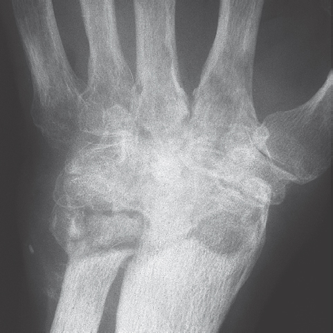 40 Infectious Arthritis | Radiology Key