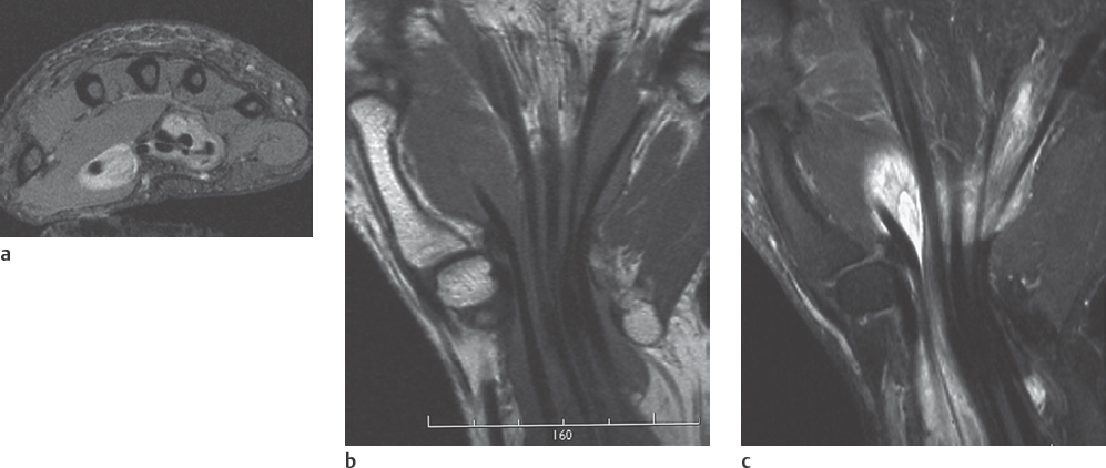 42 Infections of the Soft Tissues | Radiology Key