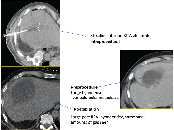1 Radiofrequency Ablation: Mechanism of Action and Devices | Radiology Key
