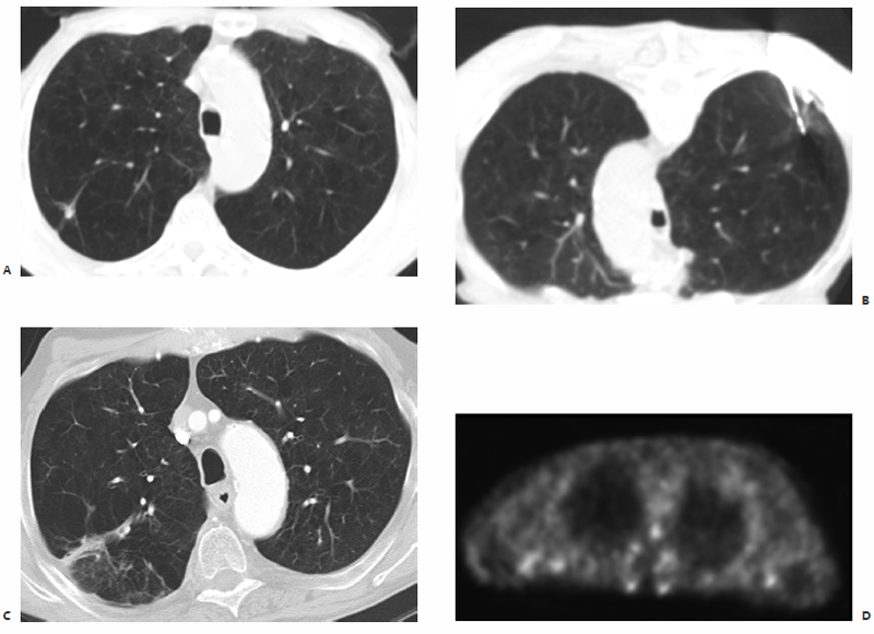 3 Microwave Ablation: Mechanism of Action and Devices | Radiology Key