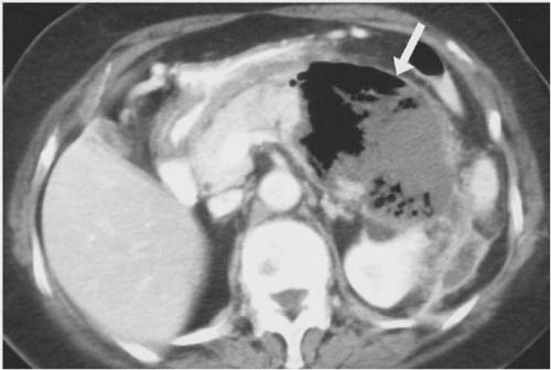 Pancreas: Differential Diagnosis of Pancreatic Diseases | Radiology Key