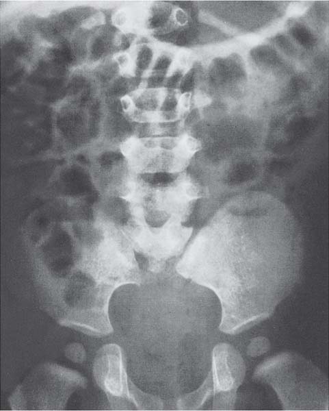 The Pediatric Vertebral Column: Anomalies of Vertebral Body Shape and ...