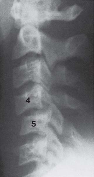 The Pediatric Vertebral Column: Anomalies of the Intervertebral ...