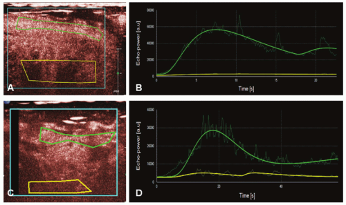 Ultrasound Perfusion Imaging: Techniques and Analytical Methods ...