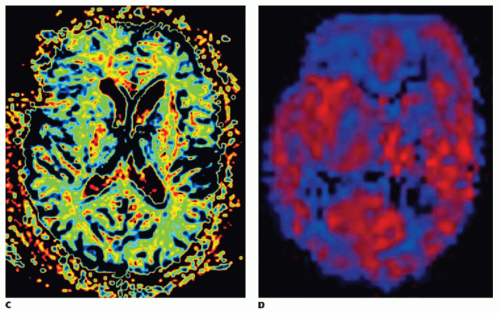 Clinical Applications of ASL Brain Perfusion Imaging | Radiology Key