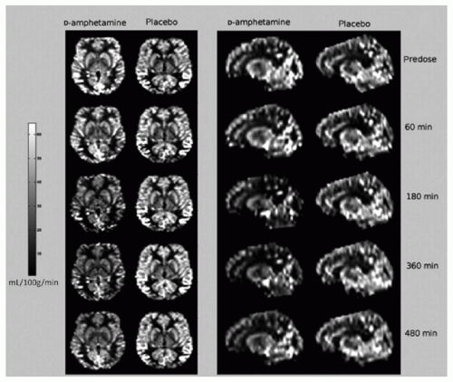 Perfusion MR Imaging in Cognitive and Developmental Brain Disorders and ...