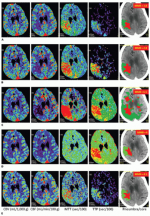 Brain CT Perfusion Imaging: Cerebral Ischemia | Radiology Key