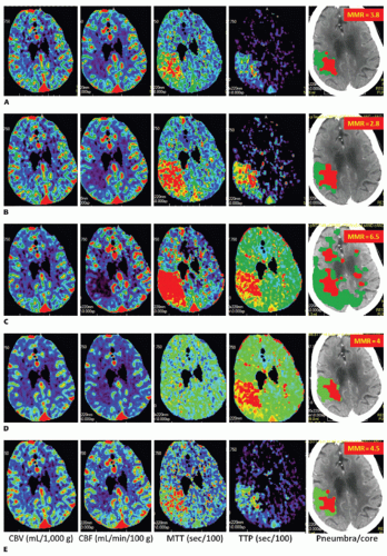 CT Perfusion Imaging Principles | Radiology Key